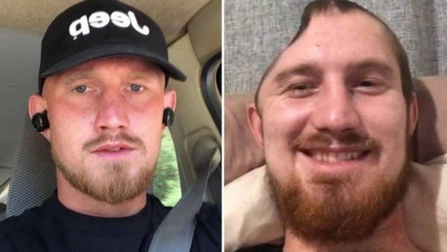 Britânico tem quase a metade do crânio removida após briga em bar ...