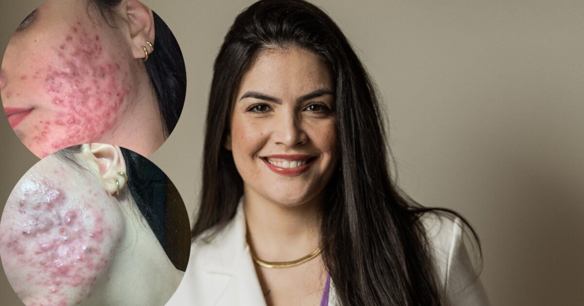 Terapeuta desenvolve método natural para controlar a acne e resultado ...