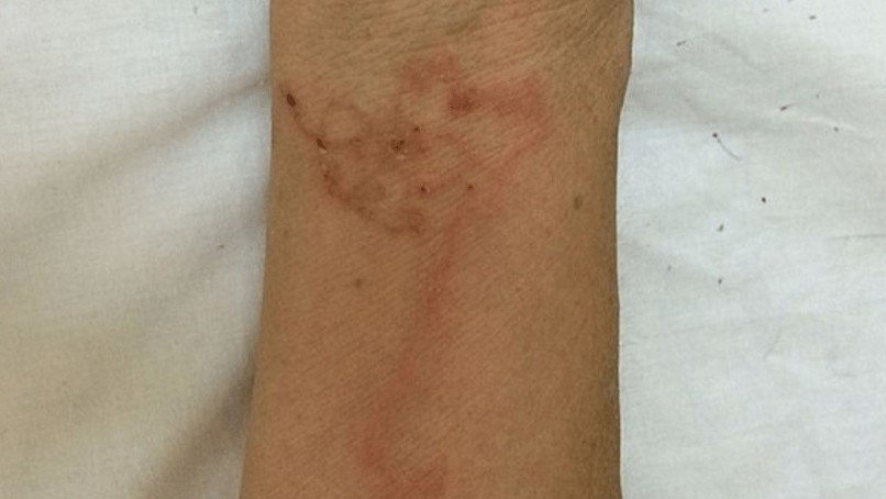 Vietnã: Mulher é internada com vermes parasitas rastejando sob a pele ...