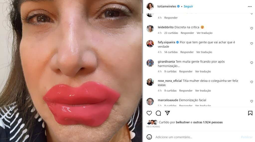 Totia Meireles ironiza harmonização facial e web aponta indireta ...