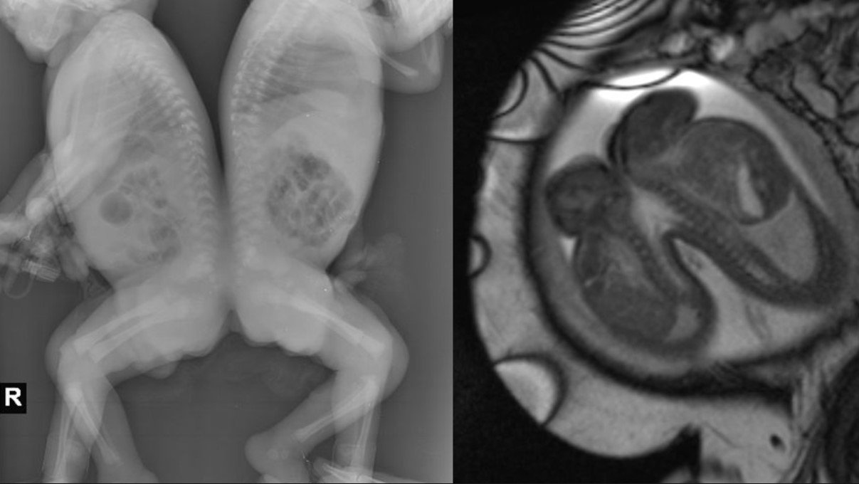 PR: gêmeos siameses nascem unidos pelo quadril; condição é considerada ...