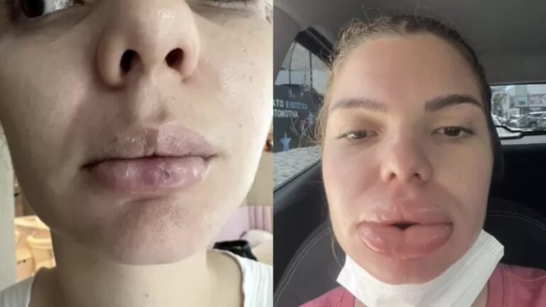 Preenchimento labial: como é feito e o que acontece quando dá errado ...