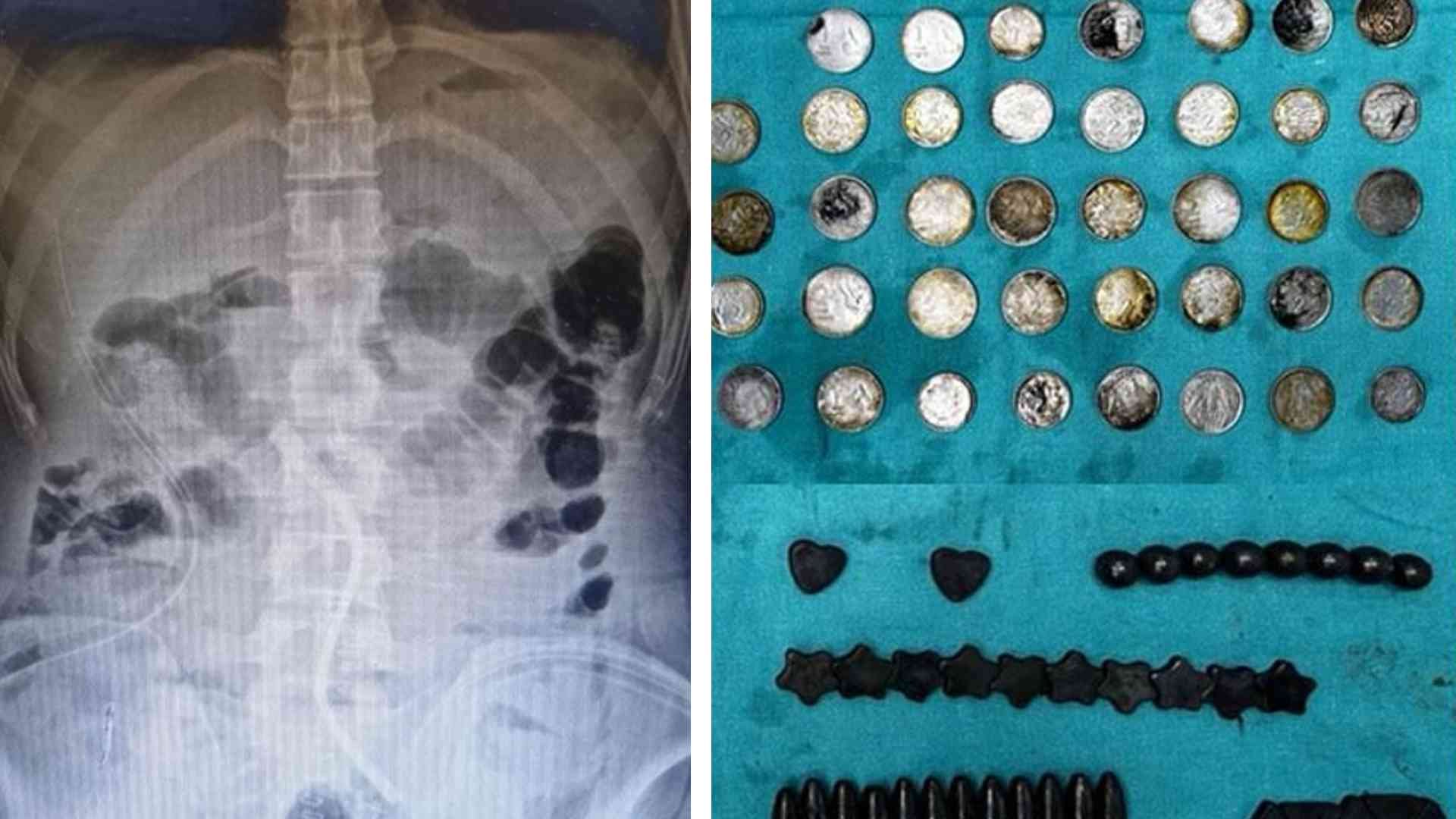 Homem engole 39 moedas e 37 ímãs para tentar aumentar desempenho na ...