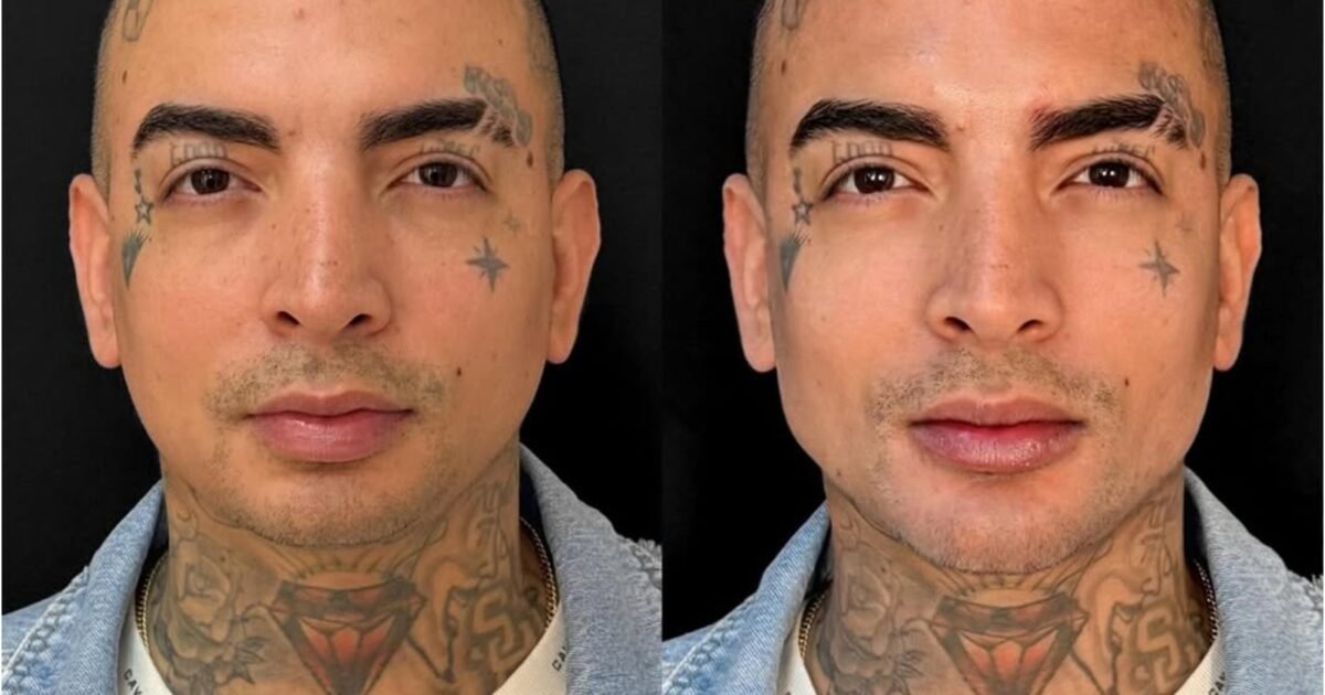 MC Guimê compartilha antes e depois da harmonização facial: ‘O pai ...