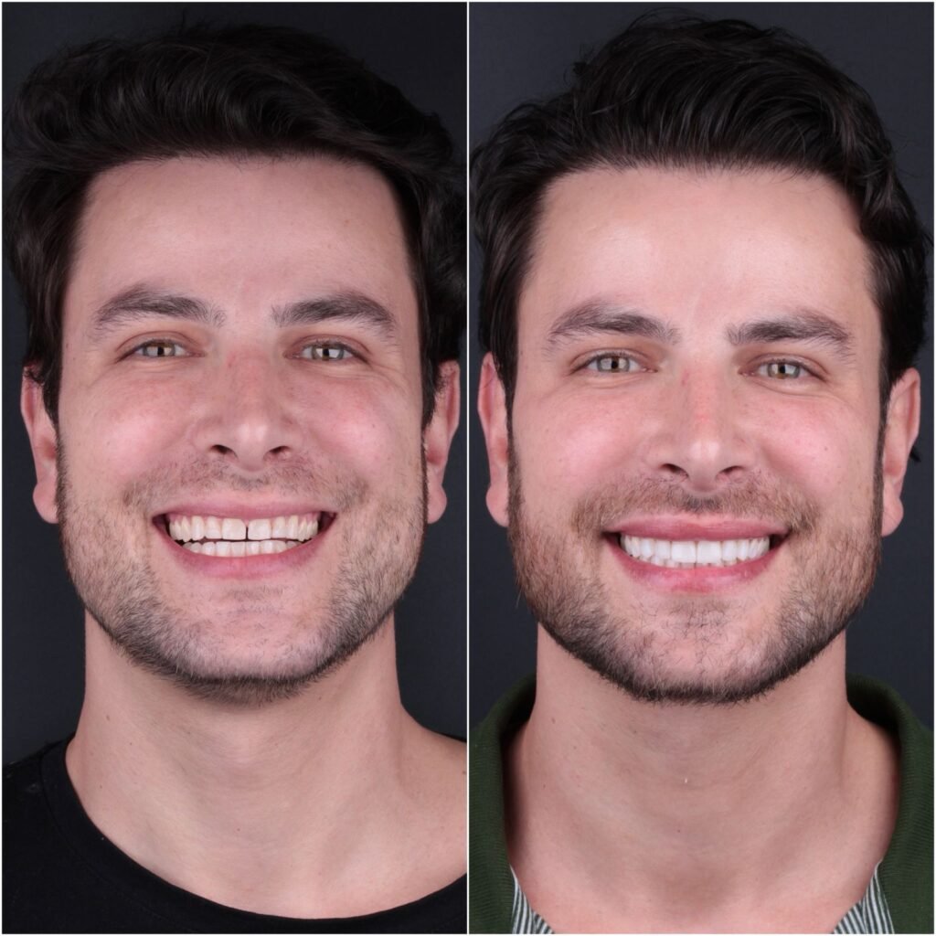 Gustavo Marsengo aposta em transformação no sorriso antes do casamento ...